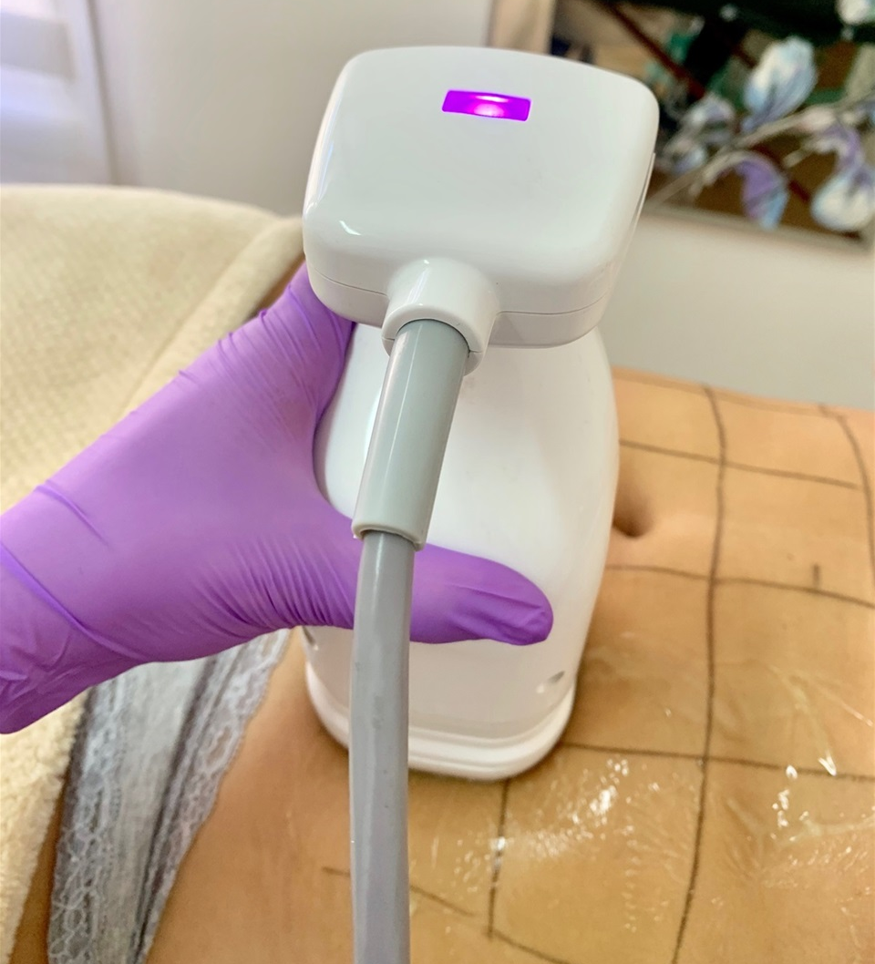 Liposonix – Spa Figura Perfecta